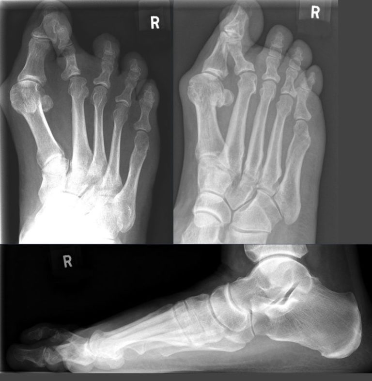 Bunion Causes and Treatments: What You Need to Know